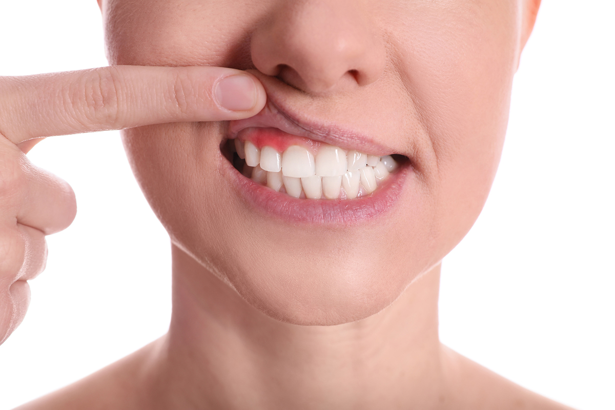 Deep Cleaning for Gum Disease - Smiles On The Upper Westside